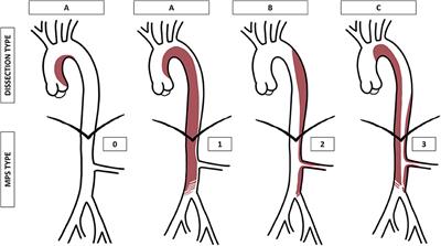 Aortic Dissection Cross Section